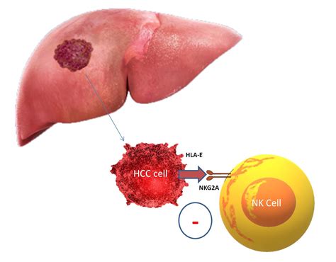Non Classical Hla Class 1b And Hepatocellular Carcinoma