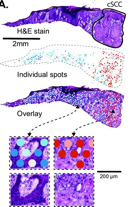 Somatic Point Mutations Are Detectable In Spatial Transcriptomics Data
