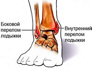 Магнитотерапия при переломе лодыжки, на какой день назначается ...