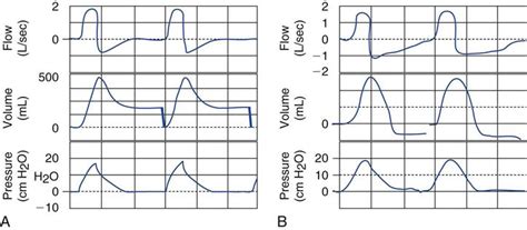 Ventilator Graphics Thoracic Key