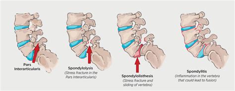 Spondylosis Spondylolysis Spondylolisthesis Motus Physical Therapy