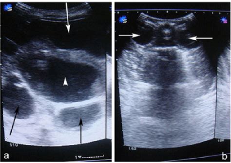 Figure 1 From Persistent Cloaca Lessons Learnt From A Case Semantic