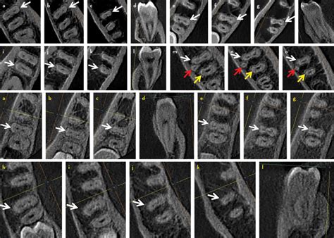Main Root Canal Types Found In Msms Roots With Two Separated Roots