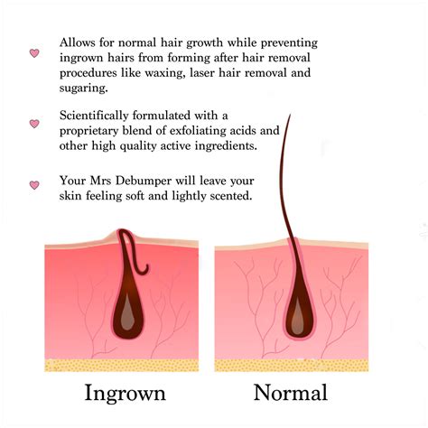 Ingrown Hair Scrotum Treatment