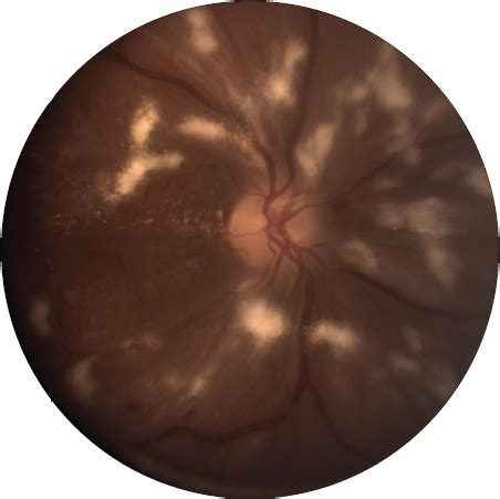 Retinal Physician Pentavision