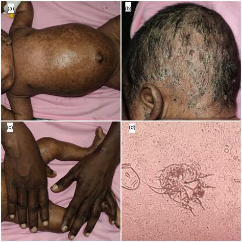Crusted Scabies Scalp