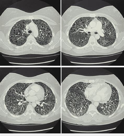 CT Chest Demonstrating Extensive Cystic Changes Throughout The Lungs Download Scientific