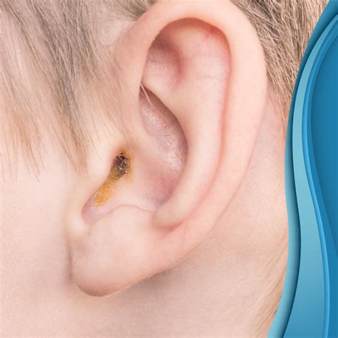 What Is Ear Wax Crystal Clear Clinic