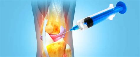 Can You Receive Multiple Corticosteroid Injections