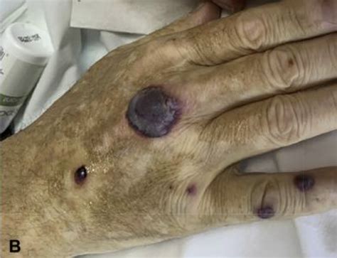 Avi Bitterman Md On Twitter Ddx