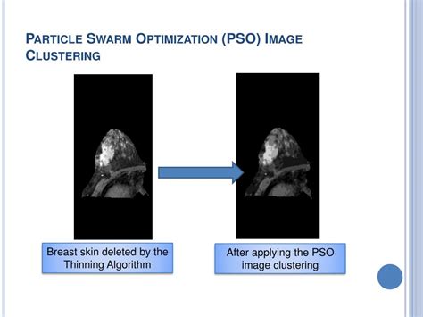 Ppt Breast Mri Tumour Segmentation Using Modified Automatic Seeded