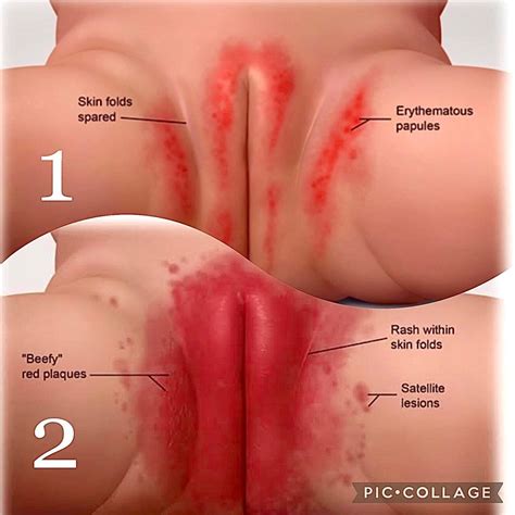🌟nappy Rash🌟 Afghan Healthwatch مراقبت افغان صحت