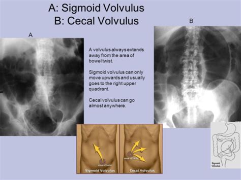 Volvulus Flashcards Quizlet