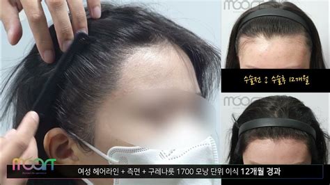 1700 모낭 여성 헤어라인 커버 여성 헤어라인 측면 구레나룻 1700모낭 단위 이식 12개월 수술경과 변화 빗질영상 모발이식 모발이식후기 Youtube