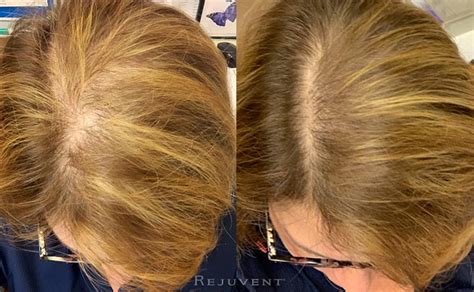 Current Specials • Rejuvent Medical Spa Scottsdale