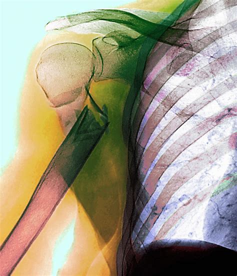 Fractured Arm 1 Photograph By Zephyr Science Photo Library Pixels