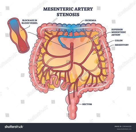 1 Mesenteric Artery Stenosis Stock Vectors And Vector Art Shutterstock