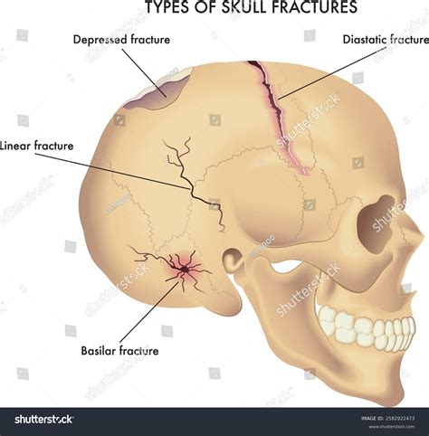 Medical Illustration Types Skull Fractures Annotations Stock Vector
