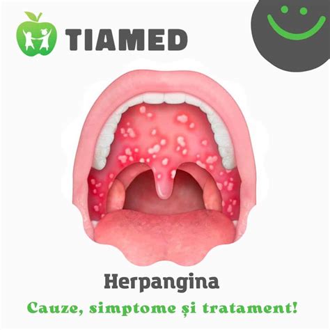 Herpangina Clinica Pediatrie Tiamed Timisoara Ecografie Transfontanelara