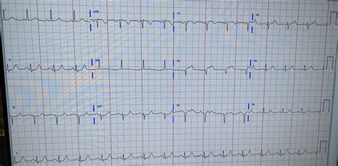 Subtle Lad Archives Dr Smiths Ecg Blog