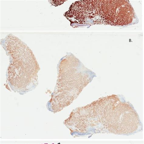 Biopsy Of The Mass Confirming Nodular Melanoma With A Breslow Thickness