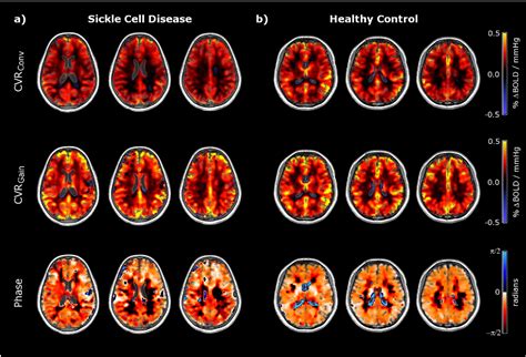 Figure 1 From Mri Based Cerebrovascular Reactivity Using Transfer Function Analysis Reveals