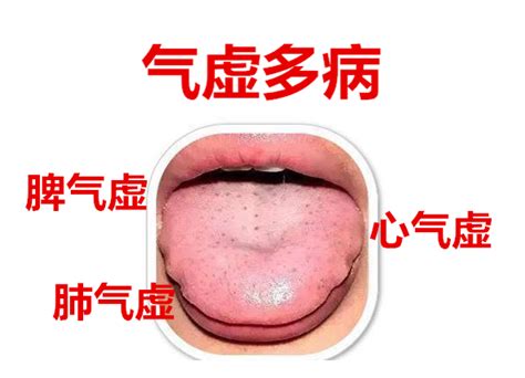 多汗是心虚,多涕是肺虚,多涎是脾虚,3个中成药,强心补肺健脾 知乎 多汗是心虚,多涕是肺虚,多涎是脾虚,3个中成药,强心补肺健脾 知乎