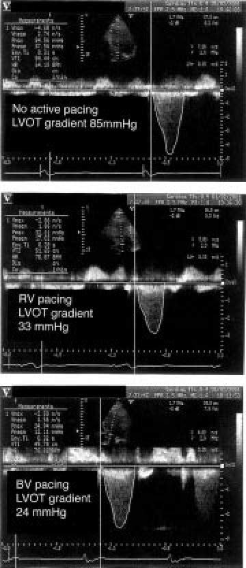 Reduction In Dynamic Left Ventricular Outflow Tract Lvot Gradient Download Scientific Diagram Reduction In Dynamic Left Ventricular Outflow Tract Lvot Gradient Download Scientific Diagram