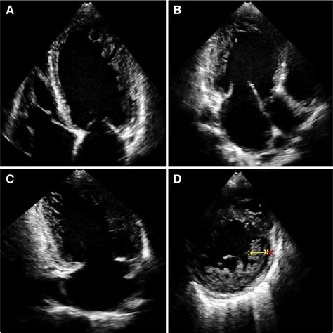 Human Immunodeficiency Virus And Left Ventricular Noncompaction