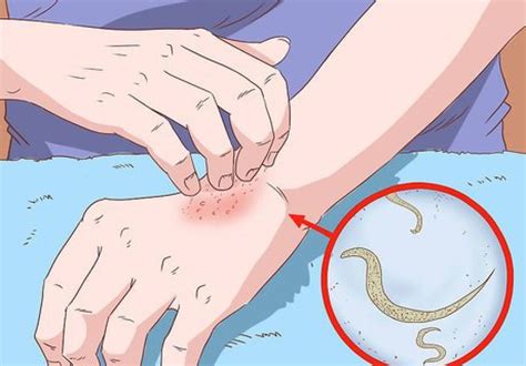 Pinworm Scotch Tape Test