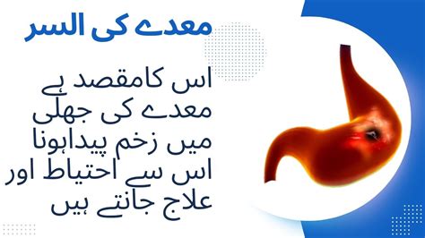 السر جو معدے کی زخم ہیکہ جس سے خون بہتاہے یہ ہر عمر کے افرادکو لگ جاتا ہے مزید معلومات ویڈیو میں