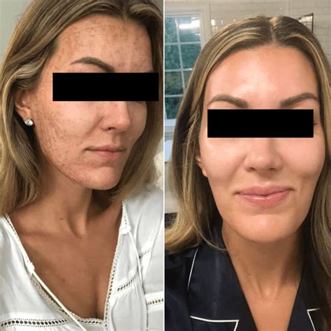 Magnus Rf 5 Mhz Machine Quantus Italy Microneedling Radio Frequency Ma