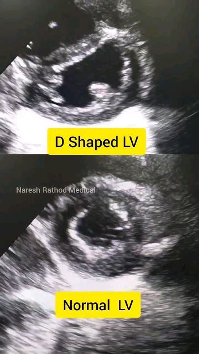 D Shaped Lv Vs Normal Lv Heart Echo Humanheart Youtube