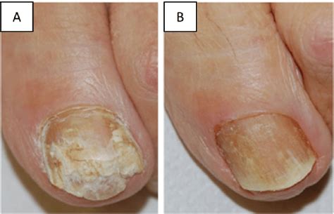 Onychomycosis Causes Clinical Appearance And Fungal Toenail Symptoms