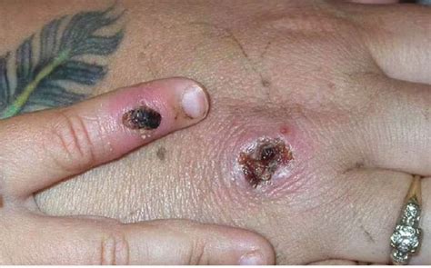 Monkeypox Is Spreading Through Sex Is It An Std Heres What To Know