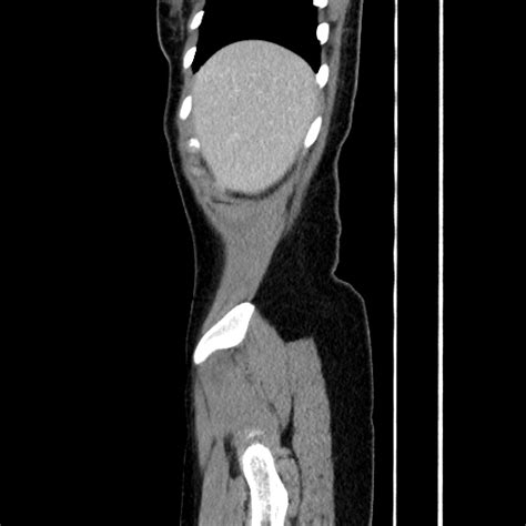 Filecrohns Disease Terminal Ileitis Fistulizing Radiopaedia 98245