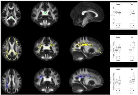 Significant Main Effect Of Sex Top Male Subjects Have Lower Fa Than