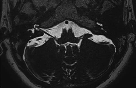Magnetic Resonance Image Of A Right Sided Type 1a Vascular Loop In A Magnetic Resonance Image Of A Right Sided Type 1a Vascular Loop In A