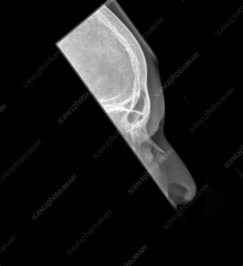 Nose Fracture X Ray Stock Image C056 4021 Science Photo Library