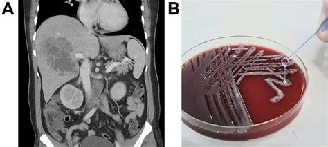 A Abdominal Computed Tomography Showing A Large Multiloculated Abscess Download Scientific