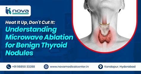 Understanding Microwave Ablation For Thyroid Health A Non Surgical