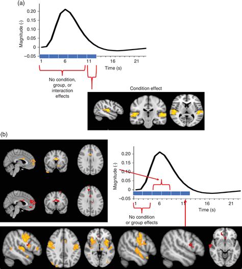 Spatiotemporal Brain Activity Associated With Hearing And Reading In Patients With Verbal