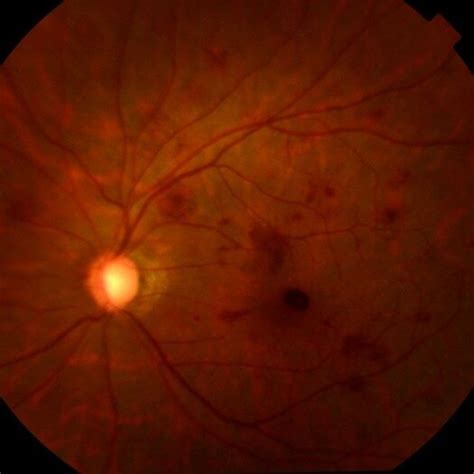A Fundus Photograph Showing Superficial And Deep Retinal Hemorrhages Download Scientific