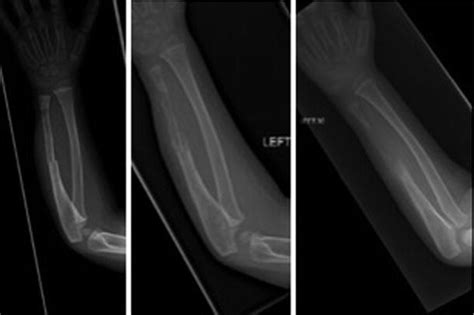 Significant Osteolytic Process Affected The Left Ulna With Dissolution