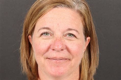 Brow Lift Patient North Beach Plastic Surgery