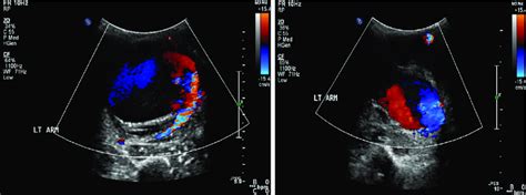 Color Doppler Us Images In A Patient With Pulsatile Distal Left Arm Download Scientific Diagram