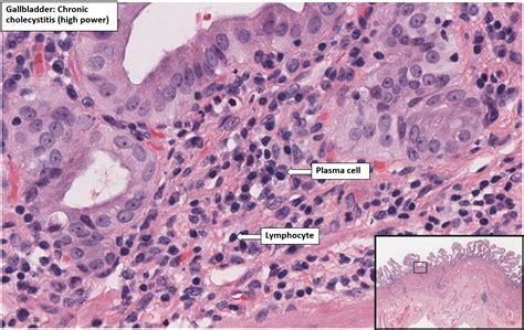 Chronic Cholecystitis