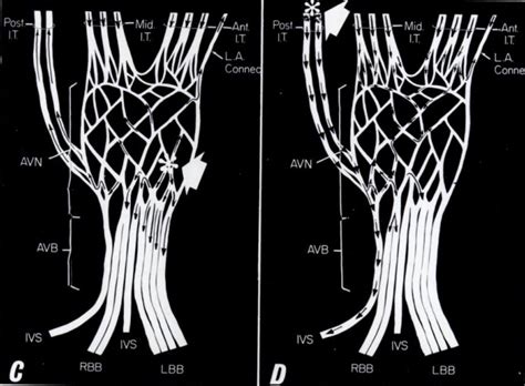 A New Electrocardiographic Concept Synchronized Sinoventricular