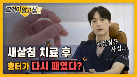 패인흉터 진실게임 새살침 효과 정말 영구적일까 ｜그것이 알고싶담🔎｜새살침 패인흉터 로담한의원 Youtube