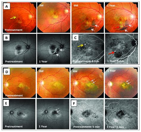 Color Fundus Auto Fluorescence Af And Indocyanine Green Angiography Download Scientific